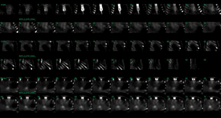 Clinical Care by D-SPECT - spectrum-dynamics